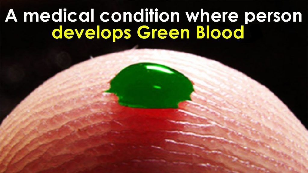 The Mystery of Green Blood: A Rare Medical Phenomenon in Surgical Cases ...